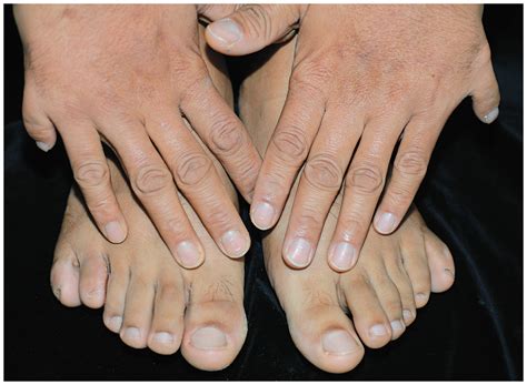 Polydactyly — Nejm
