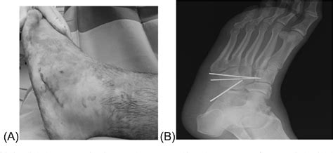 Figure 3 From An Isolated Cuboid Dislocation A Case Report Semantic Scholar