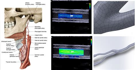Development Of Anatomically Realistic Phantom Models Of The Carotid Artery