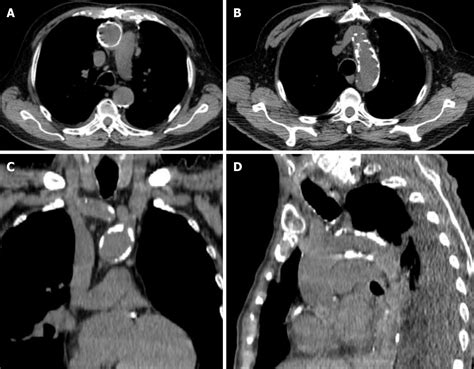 Aortic Arch Calcification