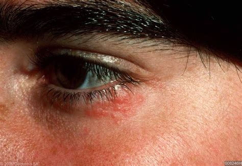 Dermatitis Perioralis