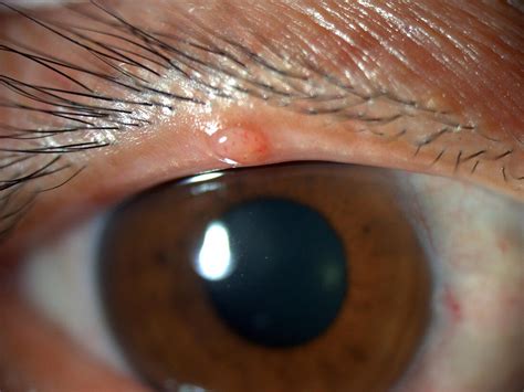 Conjunctival Cyst Bild Kaufen 12036204 Science Photo Library