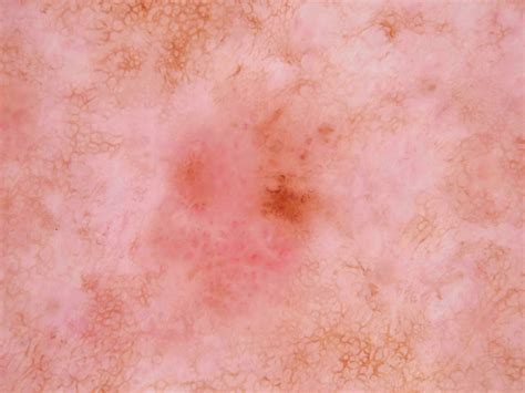 Skin Disease Prediction Using Deep Learning Devpost