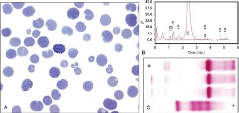 Hemoglobin And Hemoglobinopathies Clinical Tree