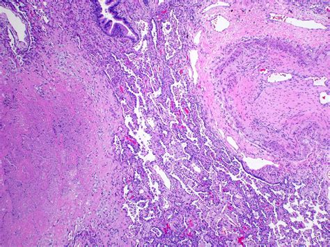 Pulmonary Embolism Pathology