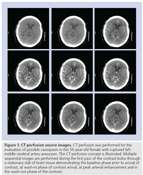 Role Of Ct Perfusion Imaging In The Diagnosis And Treatment Of Va