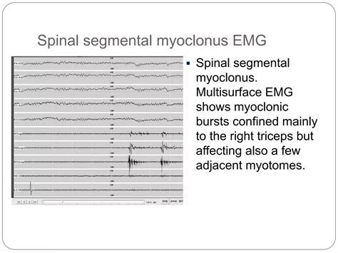 Myoclonus Seizure Pptx