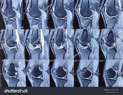 Mri Knee Joint Lateral Views Female Year Old Showing