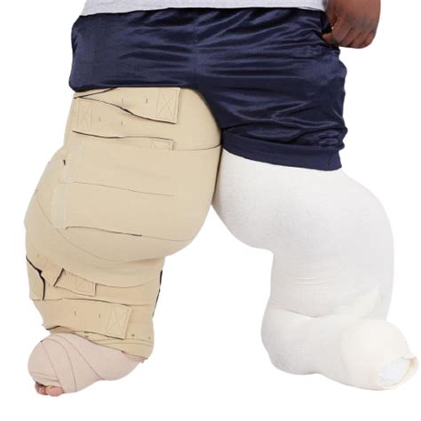 Circaid Lobe Reduction Kit Lymphedema Wrap Vitality Medical