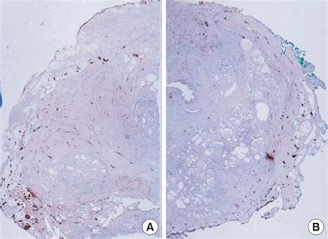 A Neurovascular Bundle Nvb Localized To The Postero Lateral Aspect