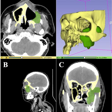 A D Ct Images A Axial Plane Reconstruction B Sagittal Plane Download Scientific