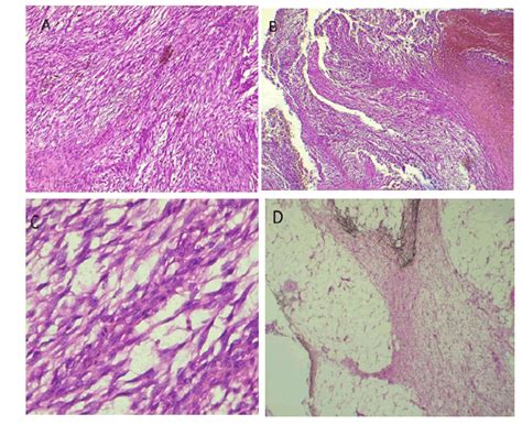 Malignant Phyllodes Tumour With Lymph Node Metastasis