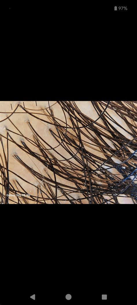 Got A Trichoscopy Done R Hairloss