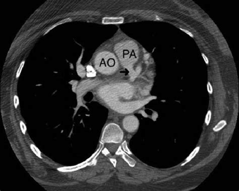 Ct Angiogram Showed The Anomalous Origin Of The Lmca Arising From The