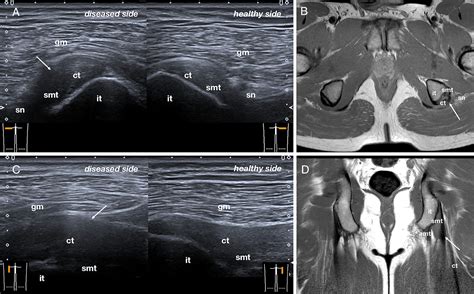 Hamstring Ultrasound Protocol At Jenenge Blog