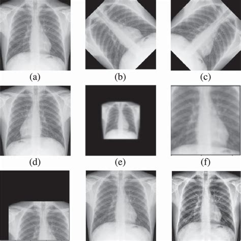 Data Augmentation Aoriginal Cxr Bc Rotated D Horizontally Download Scientific Diagram
