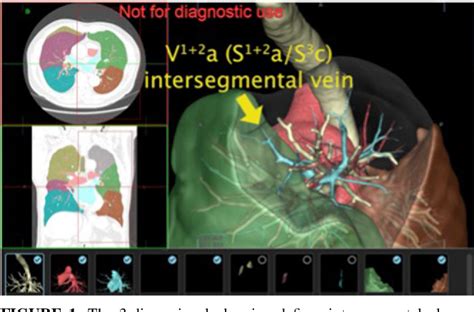 Figure 1 From Segmentectomy Oriented Anatomical Model For Enhanced Precision Surgery Of The Left