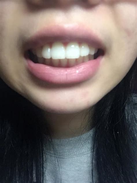 龅牙是什么样子的图片 龅牙的图片 苗苗知道