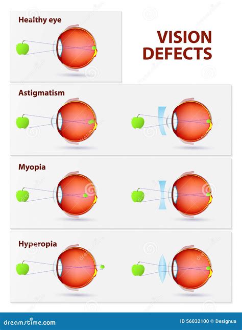 Vision Defects Myopia Hyperopia And Astigmatism Cartoon Vector