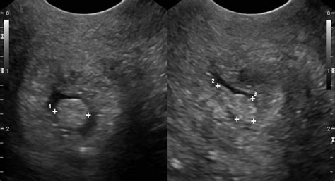 Cervical Polyp Wikipedia