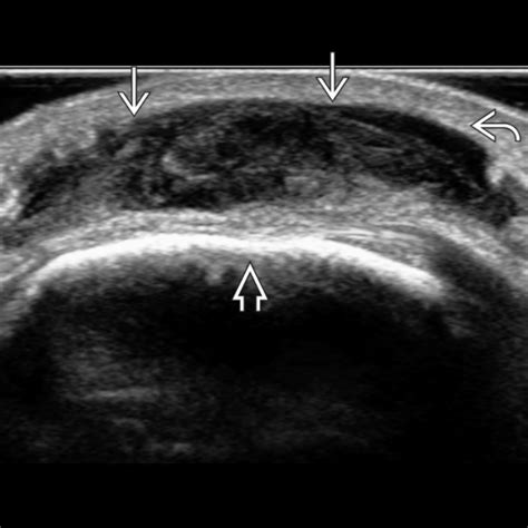Contusion Vs Hematoma