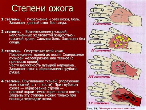 Первая помощь при ожогах и отморожениях Тема 5 презентация онлайн