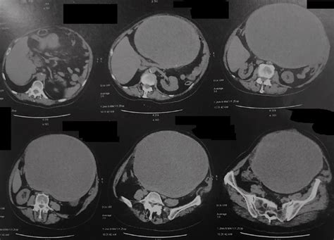 Pre Operative Ct Scan Image Download Scientific Diagram