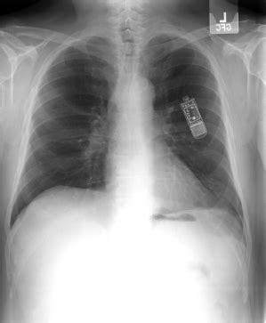 Radiography Of Implantable Devices Thoracic Key