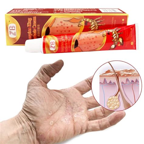 Psoriasis Cream Treatment Dermatitis Eczematoid Eczema Ointment Urticaria Desquamation Anti Itch