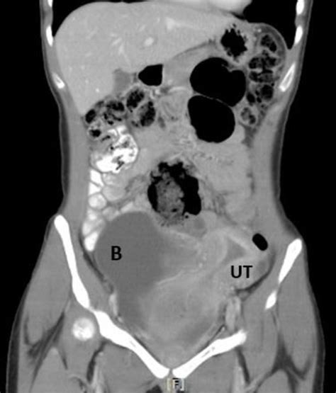 CT Scan Coronal View Showing Displaced Uterus UT To The Left Side Of