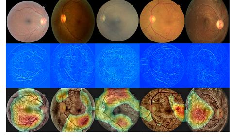 Table 1 From Feature Visualisation Of Classification Of Diabetic Retinopathy Using A