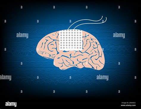 Electrode Brain Epilepsy At Michael Dittmer Blog
