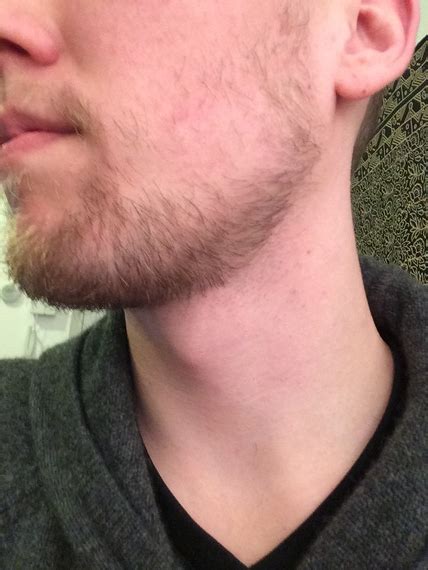 Patchy Beard Success Stories Before And After Photos Page Beard Board
