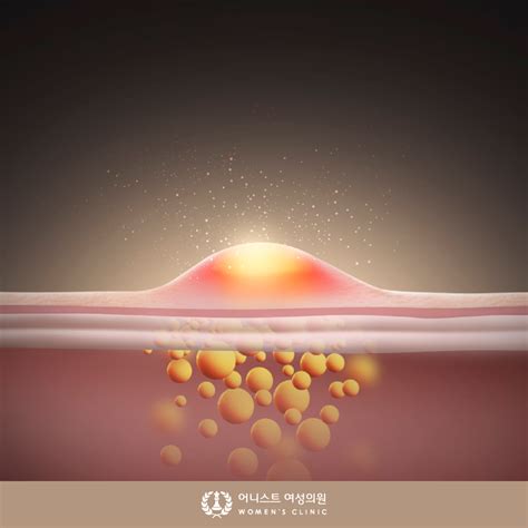 짜면 안 되는 여드름 Vs 짜도 되는 여드름 네이버 블로그