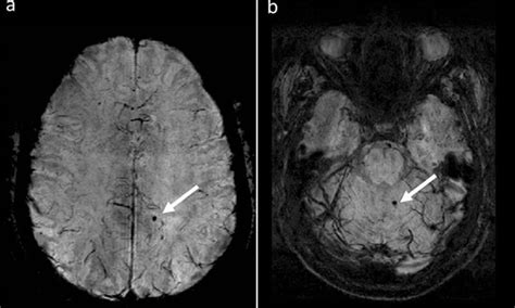 Multiple Sclerosis The Vascular Connection Cerebral Microbleeds And Ms