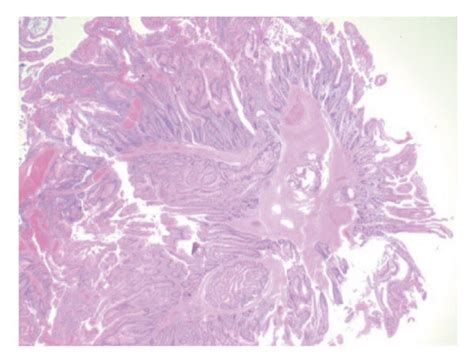 Histological Appearance Of The Peutz Jeghers Hamartomatous Polyp A