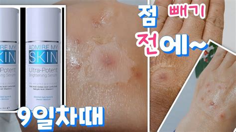 [어드마이어 마이스킨day12] 점 기미 검버섯 잡티제거법 12일사용공개 식초로점빼기 Admiremyskin Youtube