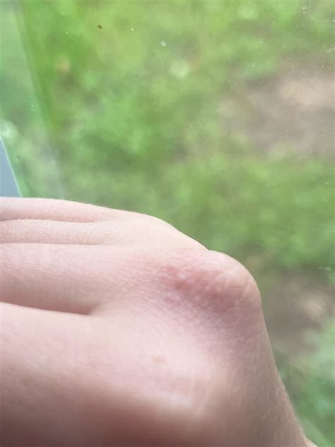 Why Do I Have Red Itchy Bumps On My Knuckles At Cynthia Forsman Blog