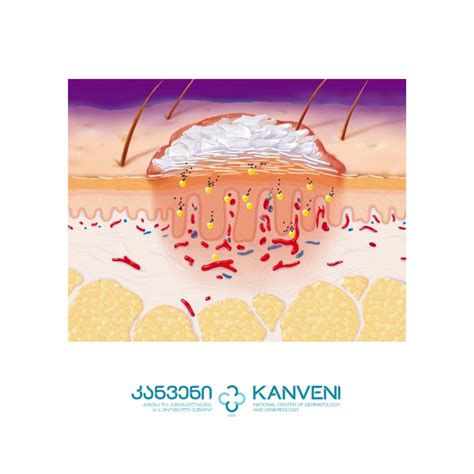 კანვენი კანისა და ვენსნეულებათა ს კ ეროვნული ცენტრი Home Facebook