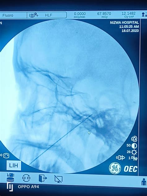 Khalid Al Rawahi On Linkedin Case Of Left Sided Trigeminal Neuralgia