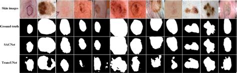 Qualitative Results Of Sacnet Versus Transunet 36 On Isic2017 Download Scientific Diagram
