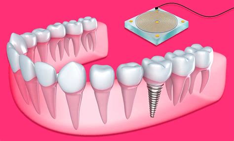 Biotech News New Sensor Integrated Within Dental Implants Monitors