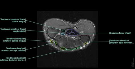Extensor Pollicis Longus Mri
