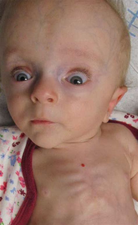 Osteogenesis Imperfecta Faces Osteogenesis Imperfecta Recent Findings