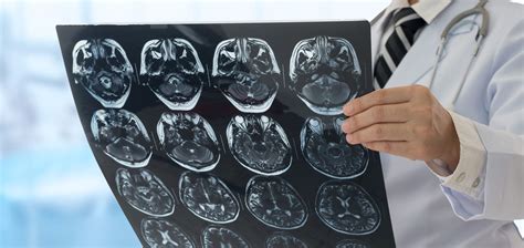 Microvascular Decompression Barrow Neurological Institute
