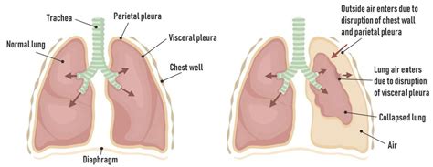 Pneumothorax TeachMeSurgery