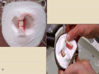 Steps Of Fabrication Of Removable Partial Denture PPTX