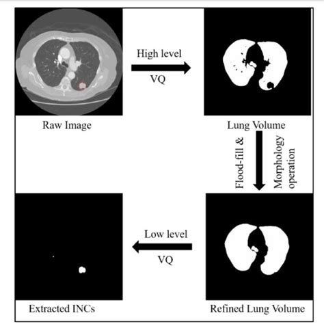 Abbreviations Cade Computer Aided Detection Ct Computed Tomography Download High