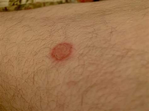 Spider Bite Or Ringworm R Dermatologyquestions