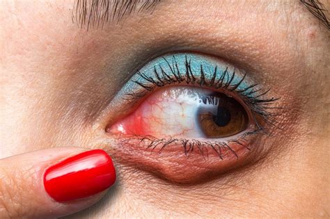 Understanding Bacterial Conjunctivitis Prevention And Treatment